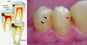 Causas de las caries - Odontologi­a Peru