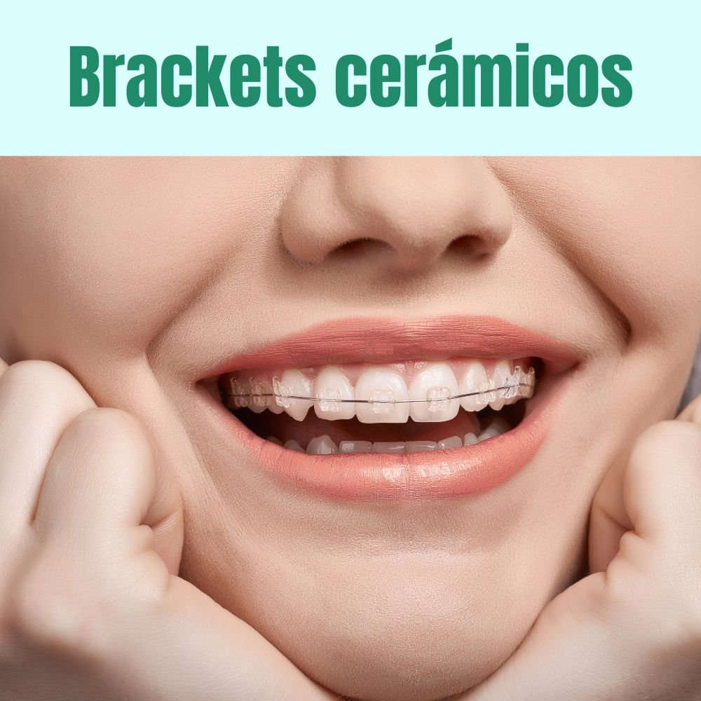 Brackets Metálicos vs Cerámicos: Guía Completa con 7 Diferencias Clave ...